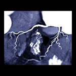 Percutaneous Coronary Intervention (PCI) Procedure Explained | Monash ...