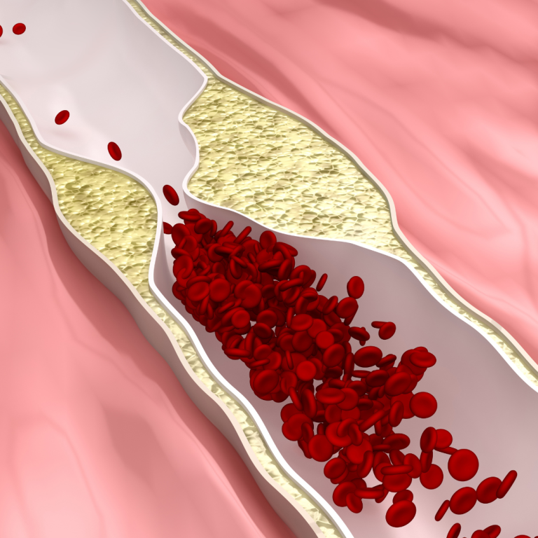 Understanding Coronary Artery Disease (CAD) | Monash Heart Private